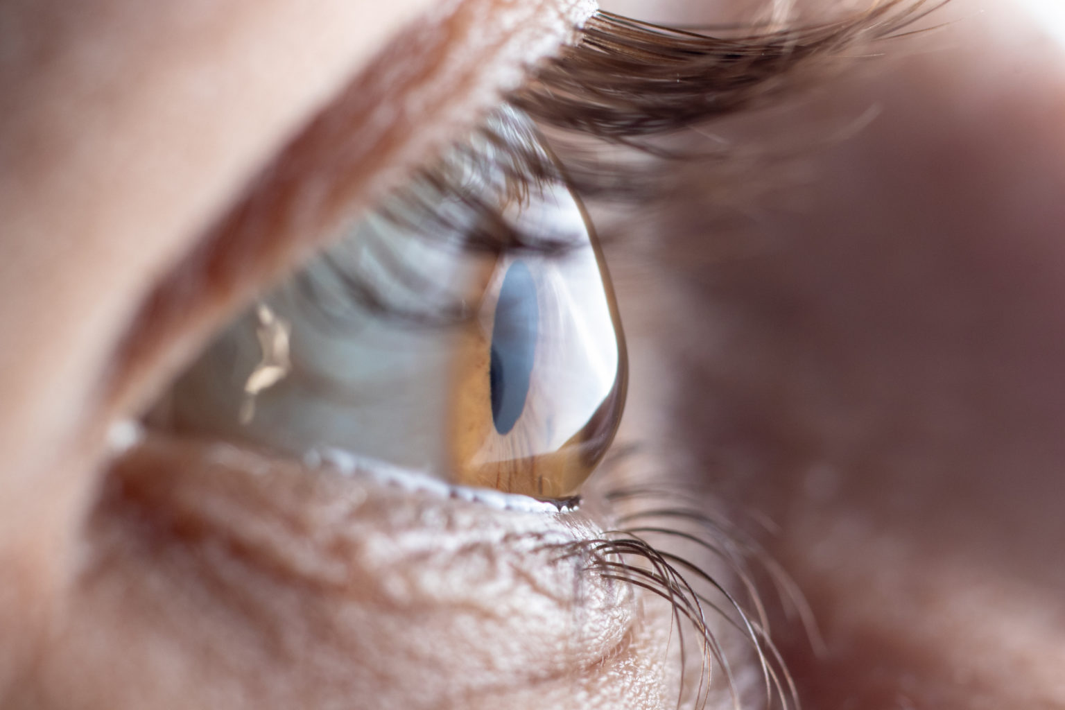 What is Keratoconus? - Pacific Vision Institute Blog